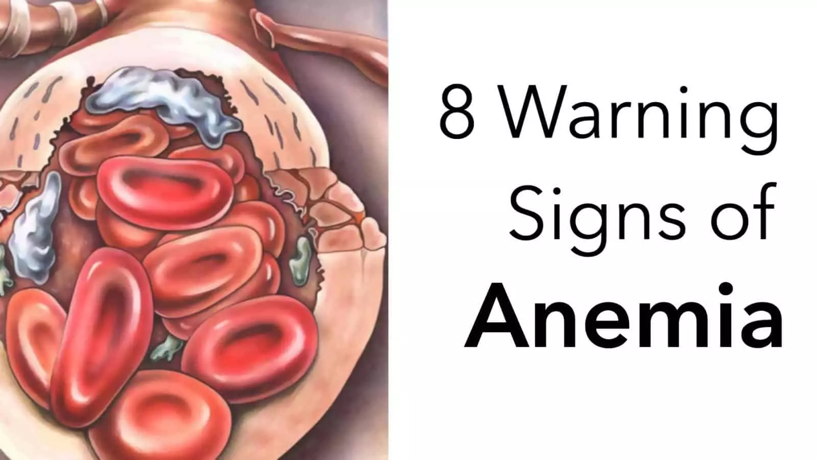 anemia