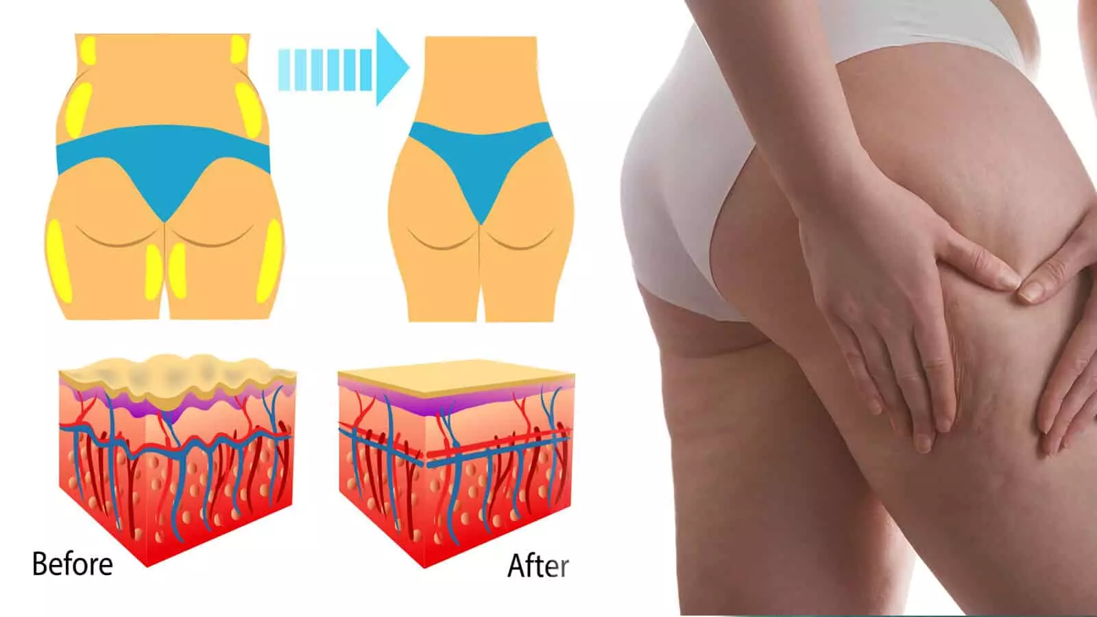 reduzéieren Cellulite